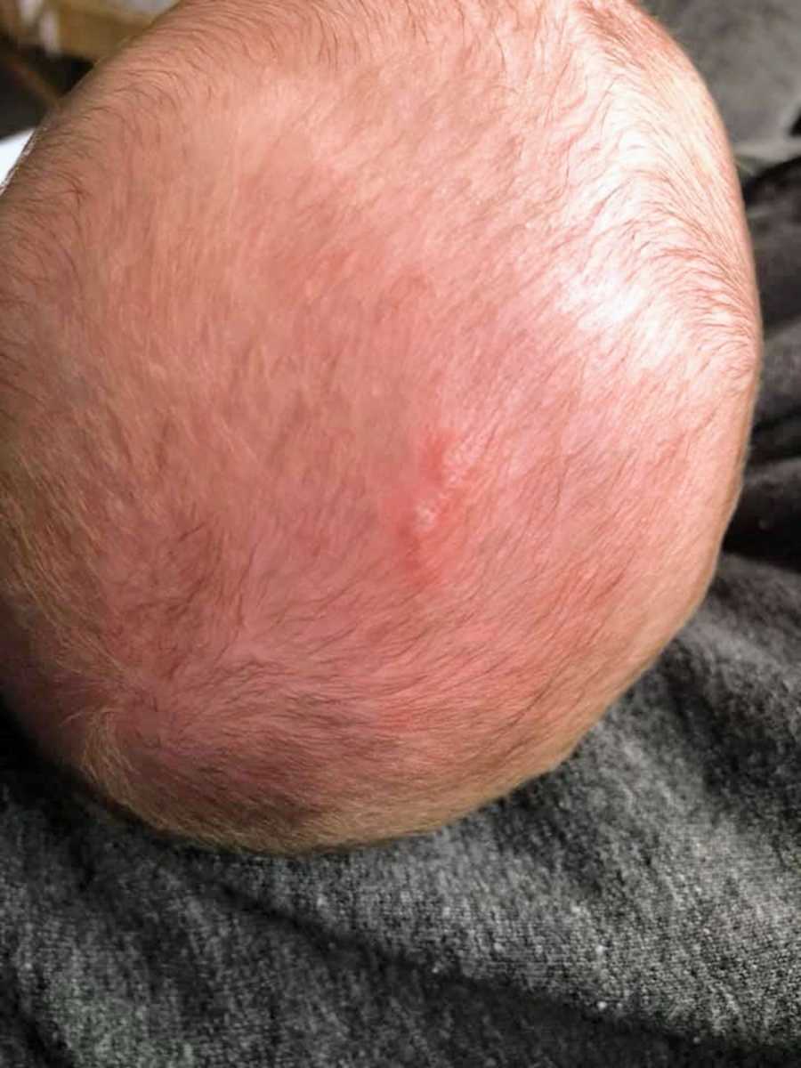 Mom Finds Red Blisters On Baby s Head After She Rushes Him To The