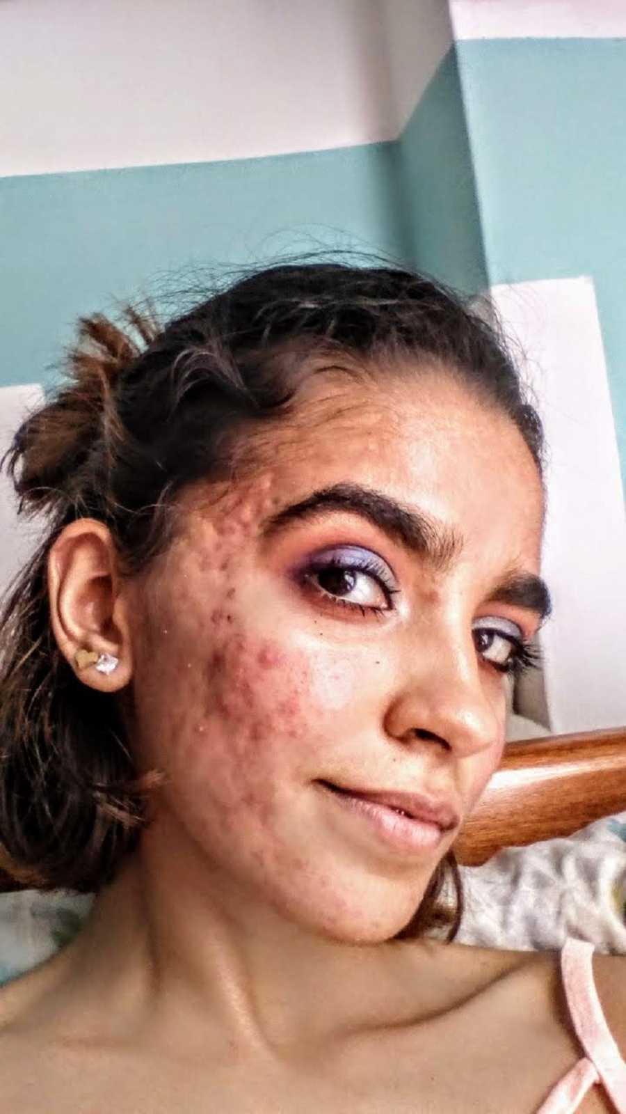 ‘How can your mom kiss you with that face?!’ My cysts were so bad they ...